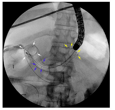 Gastrointestinal Luminal Stenting The Early US Experience with the ...