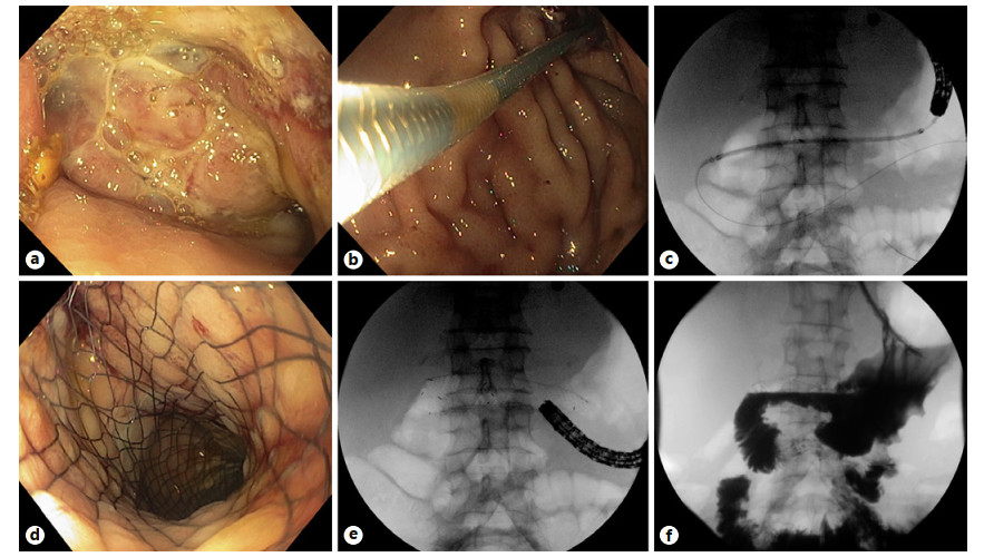 Gastrointestinal Luminal Stenting The Early US Experience with the ...