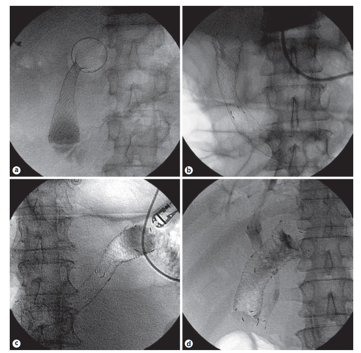Gastrointestinal Luminal Stenting The Early US Experience with the ...
