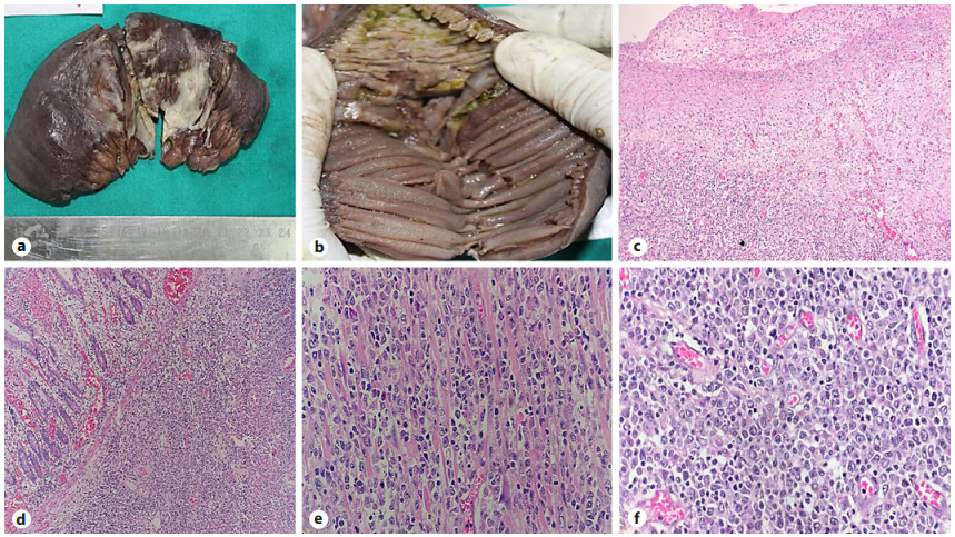 Common Presentation of an Uncommon Small Intestinal Lymphoma A Rare ...