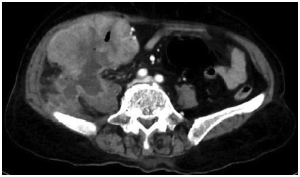 Perforated High-Grade Mixed Neuroendocrine Nonneuroendocrine Neoplasm ...