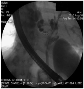 Endobiliary Radiofrequency Ablation for Malignant Biliary Obstruction ...