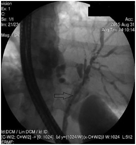 Endobiliary Radiofrequency Ablation for Malignant Biliary Obstruction ...