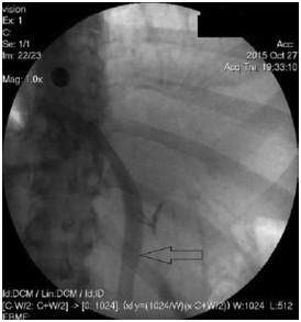 Endobiliary Radiofrequency Ablation for Malignant Biliary Obstruction ...