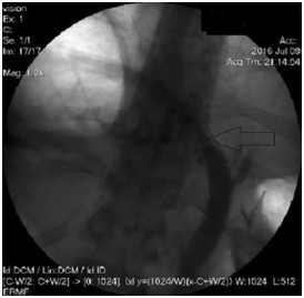 Endobiliary Radiofrequency Ablation for Malignant Biliary Obstruction ...