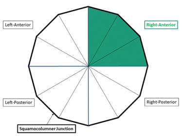 Usefulness of the Japan Esophageal Society Classification of Barrett's ...