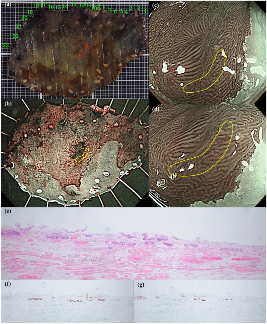 Usefulness of the Japan Esophageal Society Classification of Barrett's ...