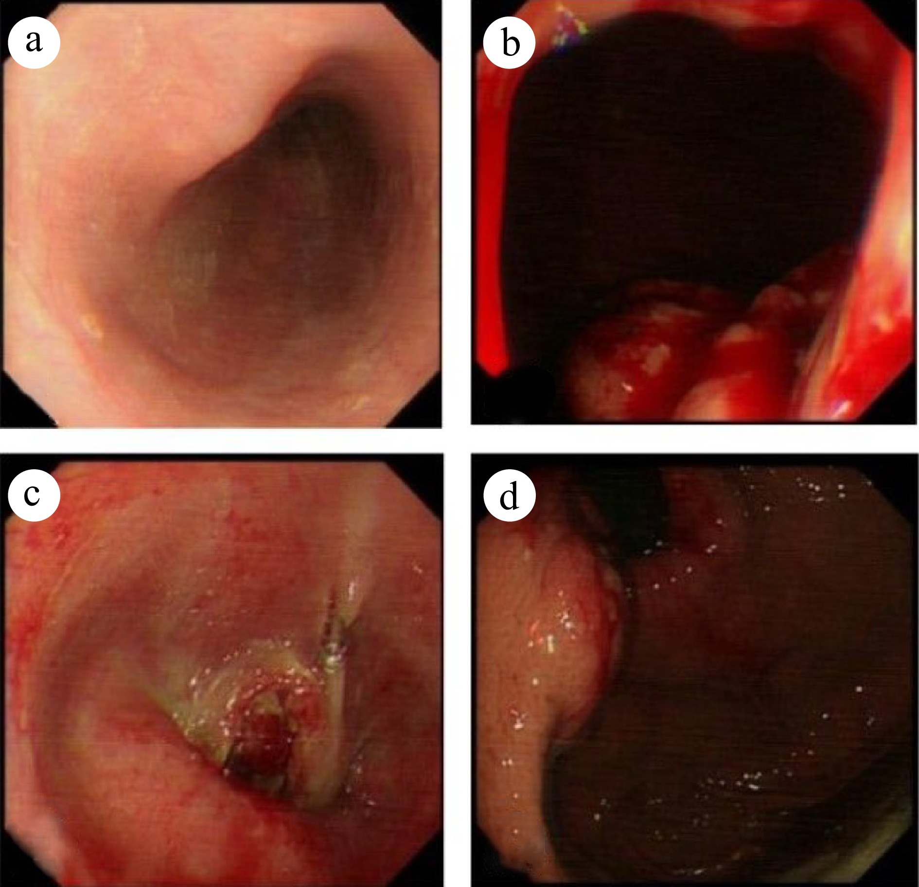 Primary Gastric Choriocarcinoma (PGC) combined with intestinal ...