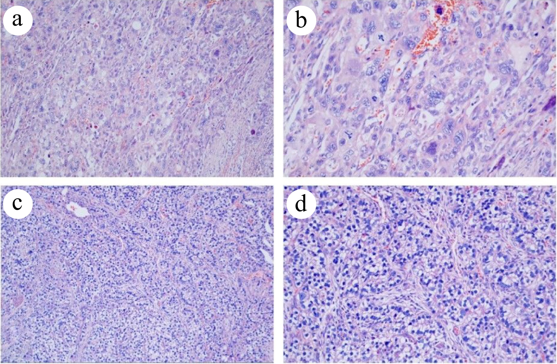 Primary Gastric Choriocarcinoma (PGC) combined with intestinal ...