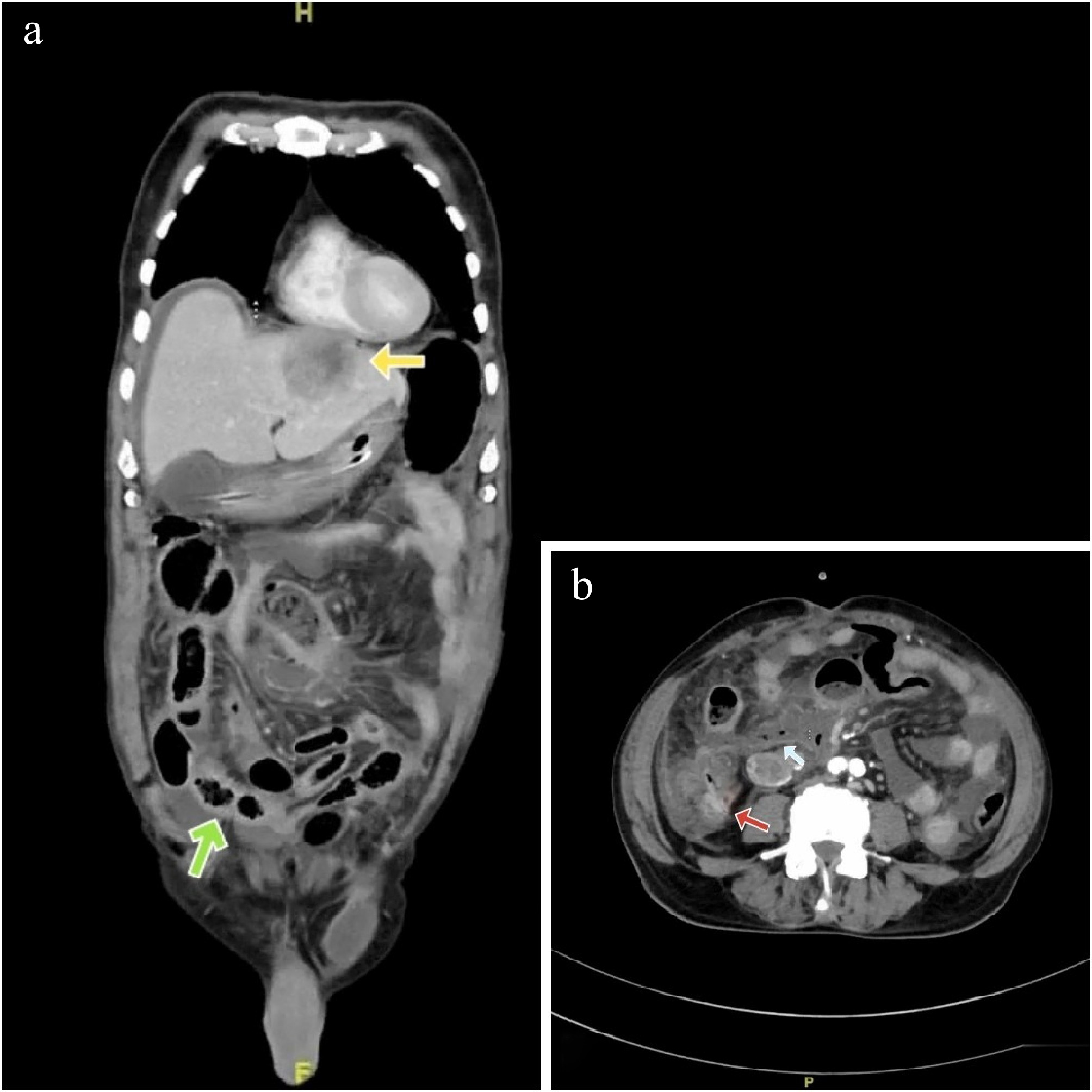 Metastatic small cell neuroendocrine carcinoma of the ileo-caecal ...