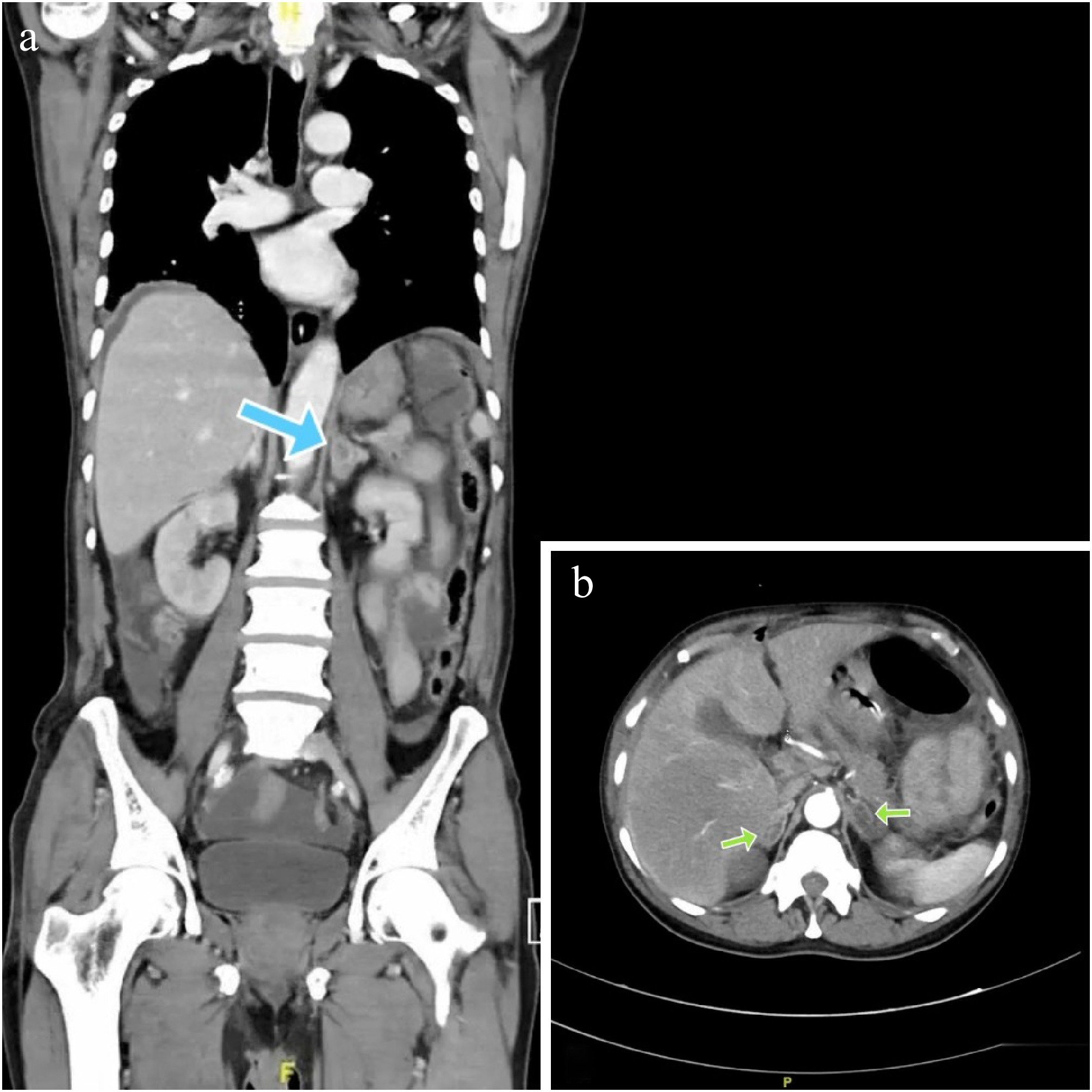 Metastatic small cell neuroendocrine carcinoma of the ileo-caecal ...