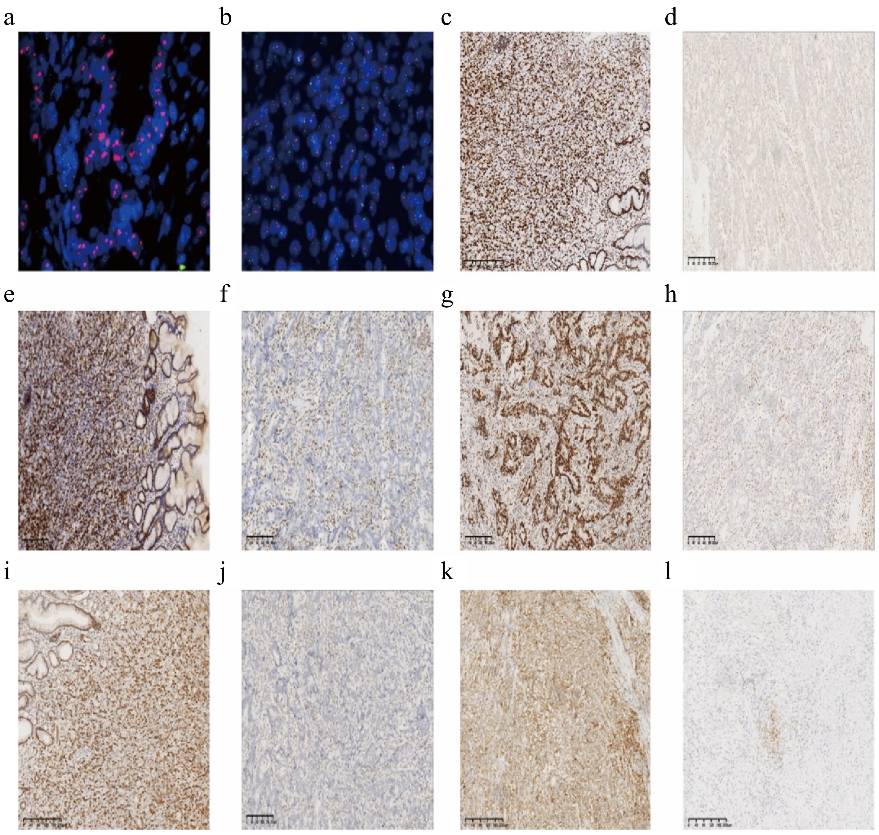 Prognostic implications of ERBB2 amplification and mismatch repair in gastric adenocarcinoma a ...