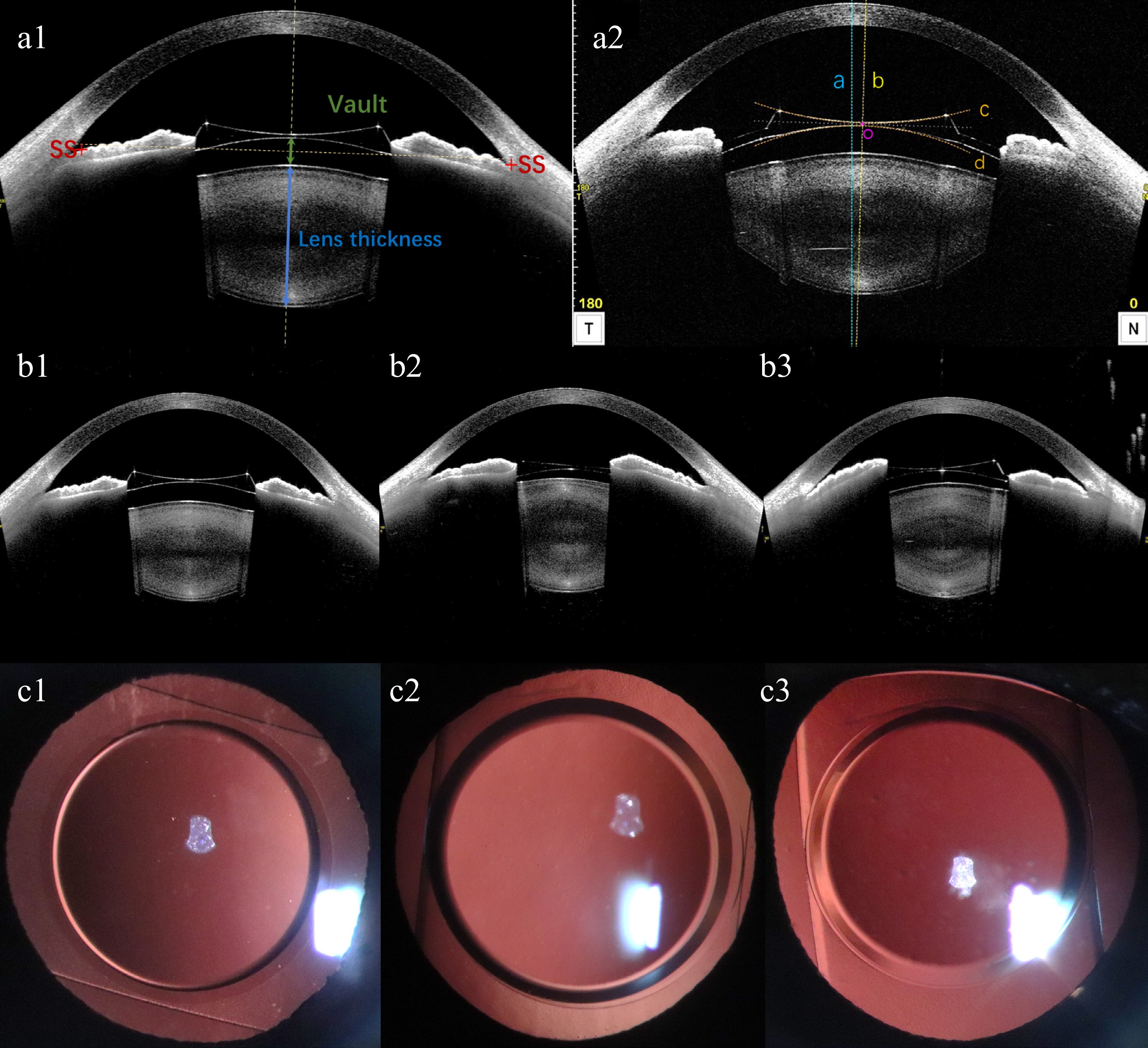 Efficacy and safety of posterior chamber Ejinn phakic refractive lens ...