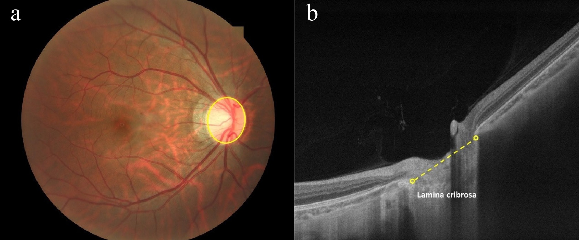 Optic neuropathy in high myopia