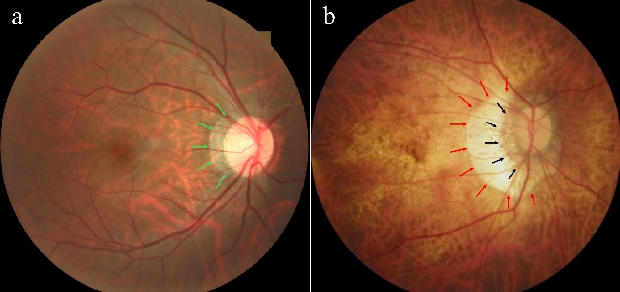 Optic neuropathy in high myopia