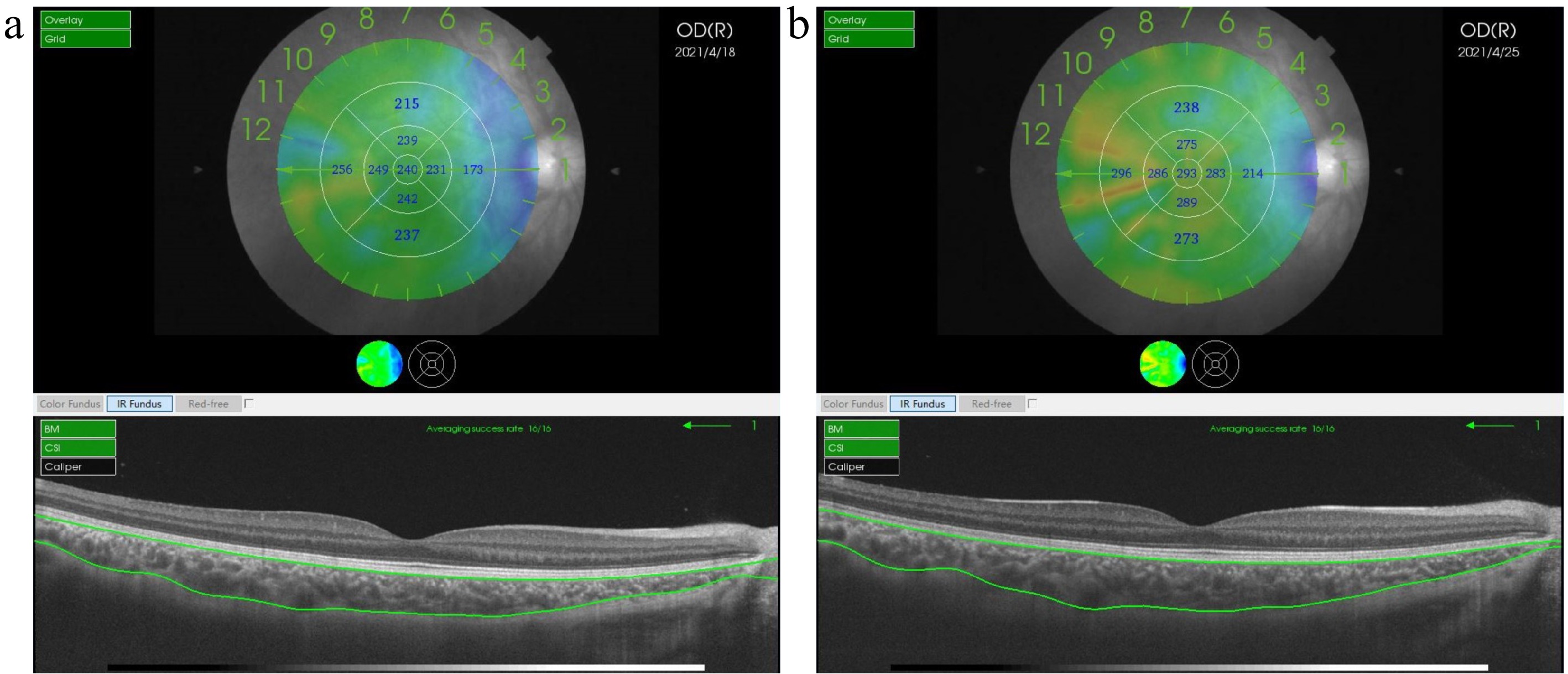 Short-term effect of 1% atropine on the thickness of the ciliary muscle ...