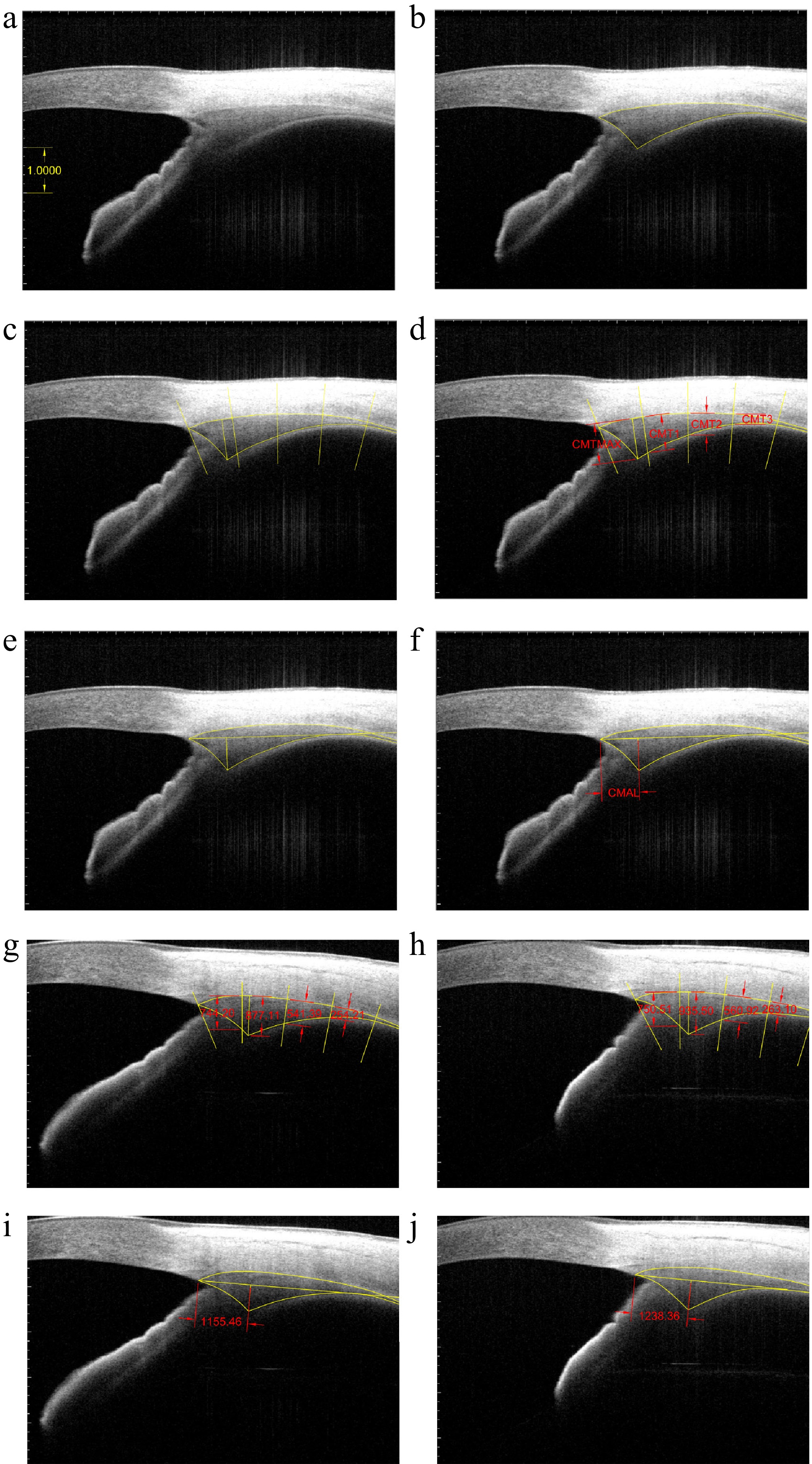 Short-term effect of 1% atropine on the thickness of the ciliary muscle ...