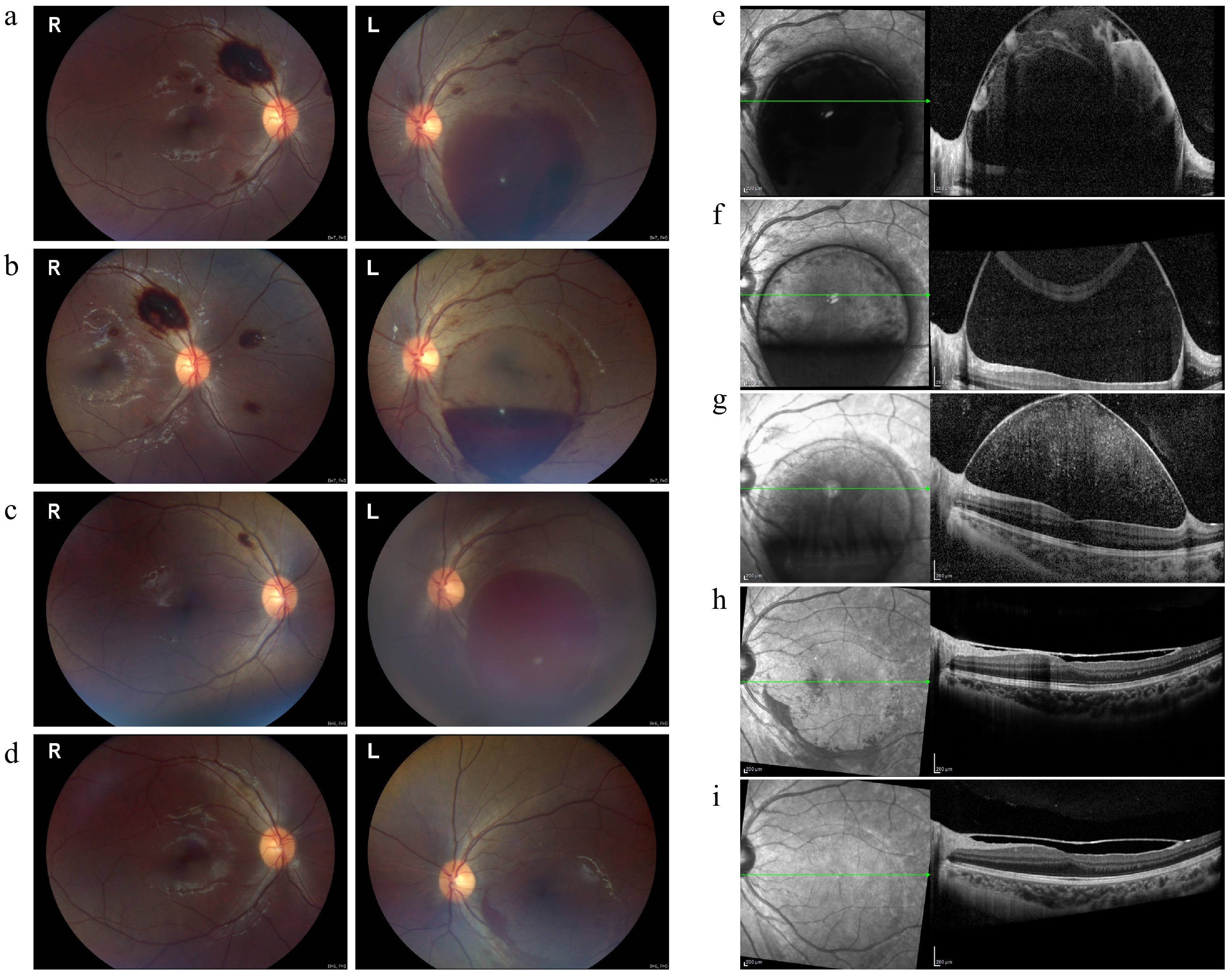 Intravitreal tissue plasminogen activator for subinternal limiting ...