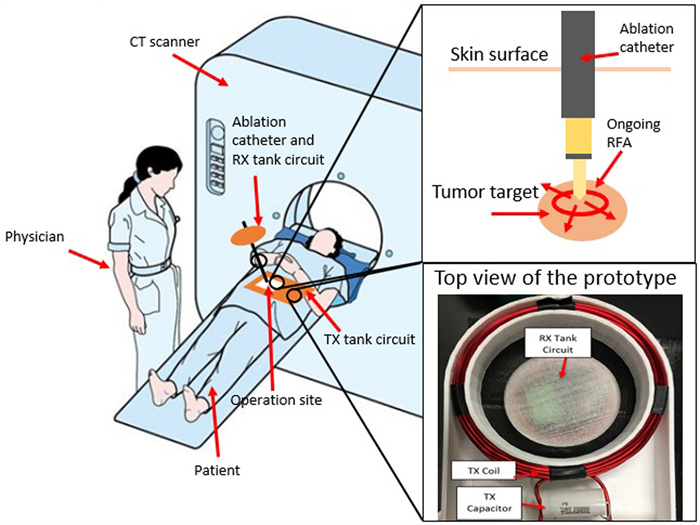 Radiofrequency tumor ablation system with a wireless or implantable probe